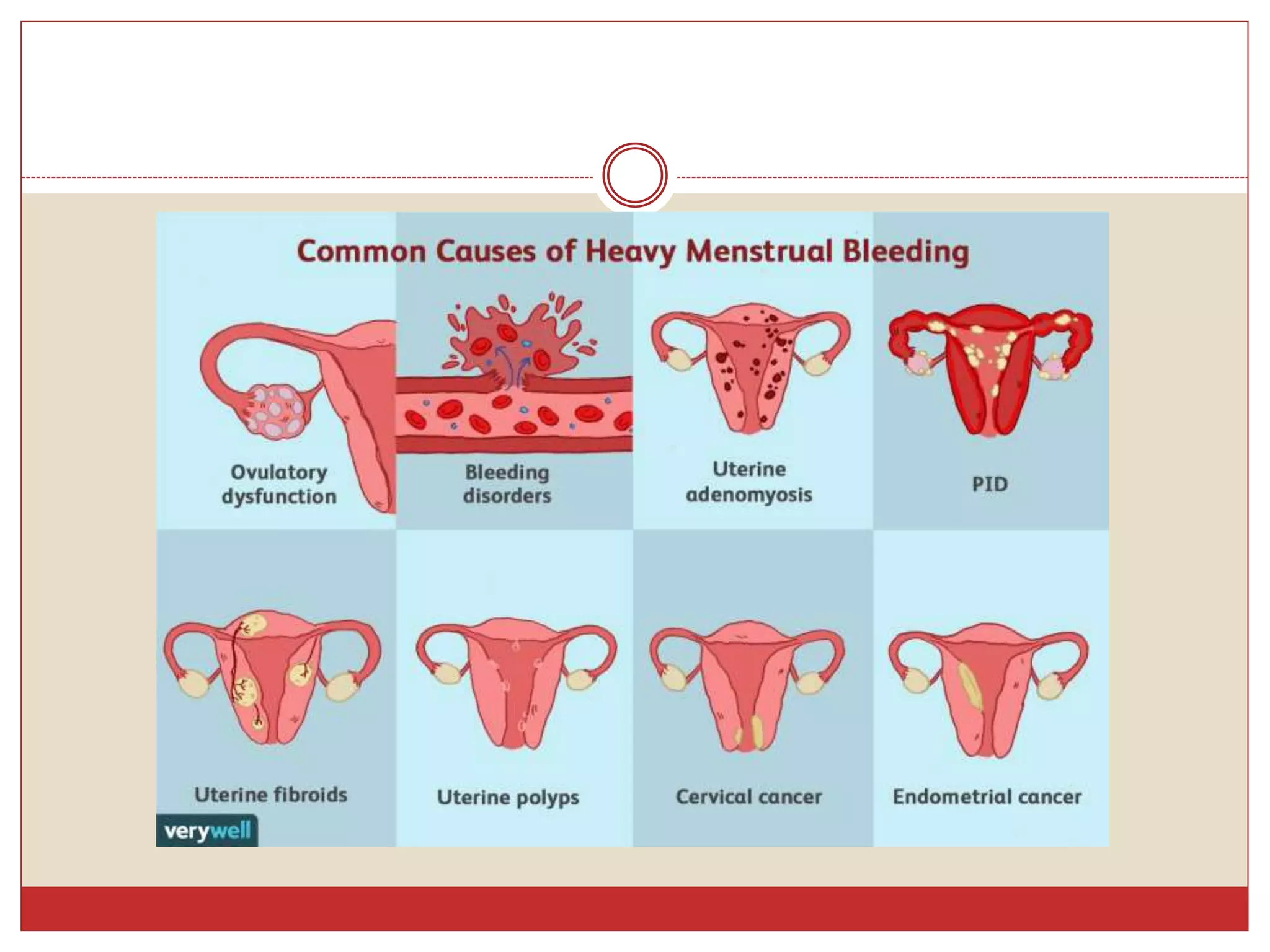Abnormal Uterine Bleeding .pptx