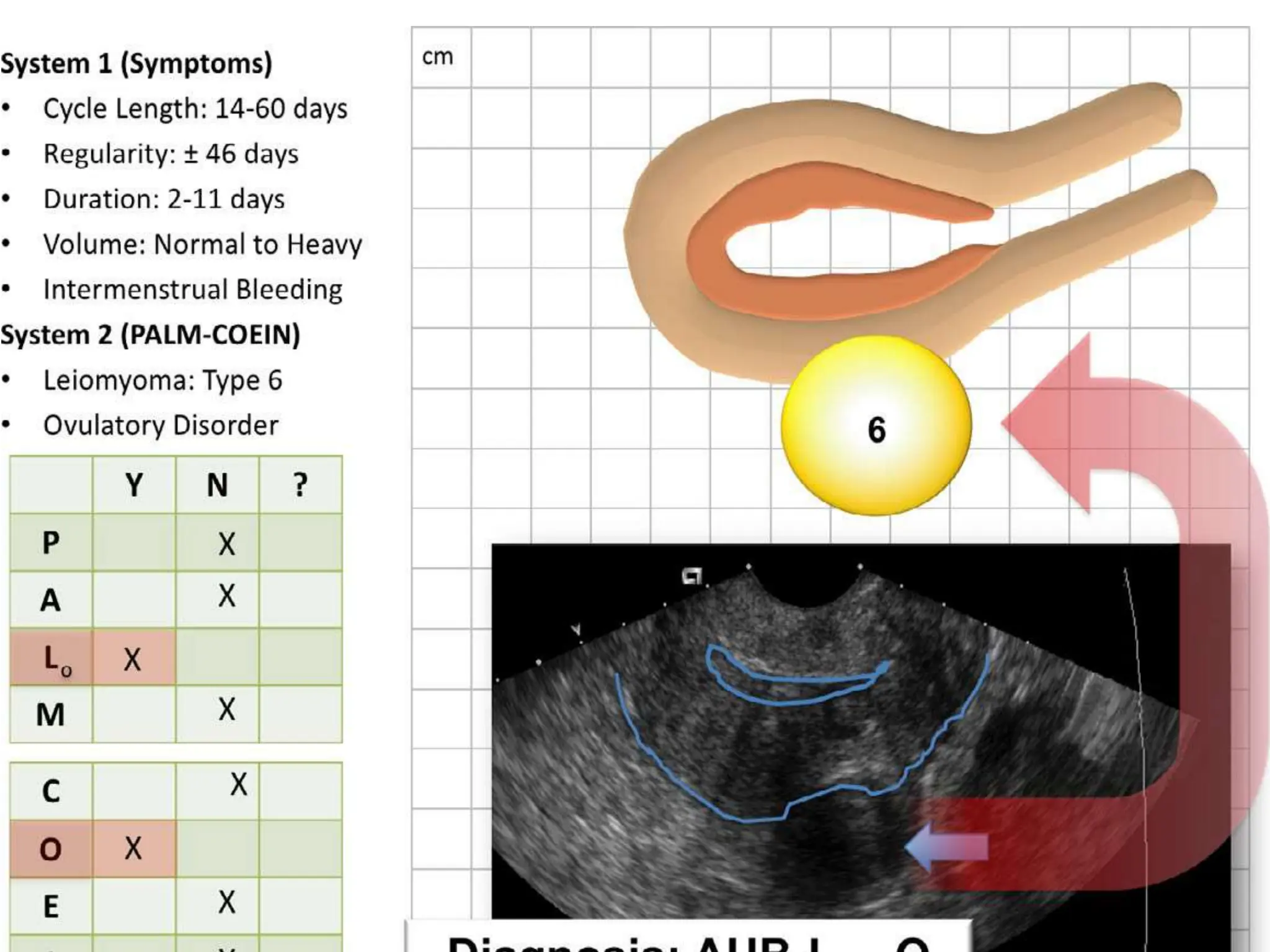 Abnormal uterine bleeding .pptx