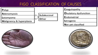 Abnormal Uterine Bleeding (AUB) -Etiopathogenesis | PPTX