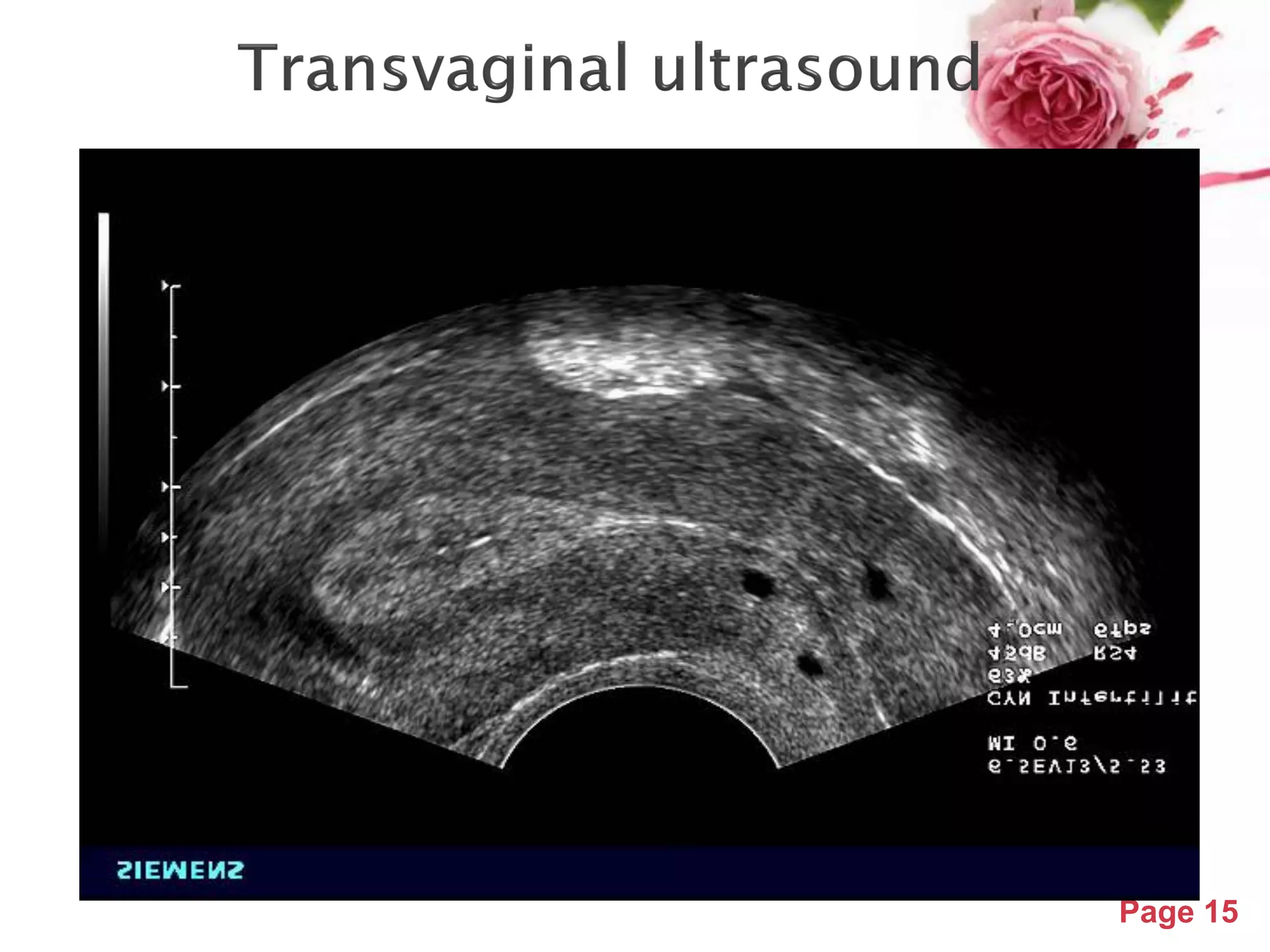 Abnormal uterine bleeding prof jamiyah hassan | PDF