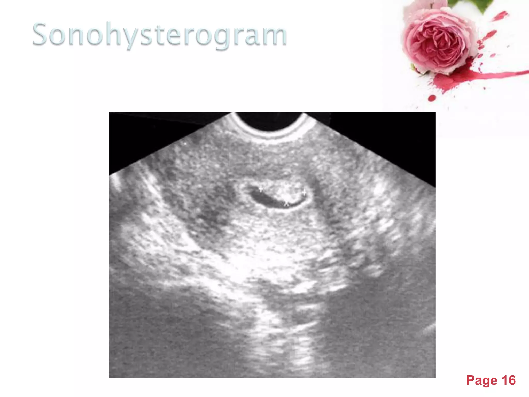 Abnormal uterine bleeding prof jamiyah hassan | PDF