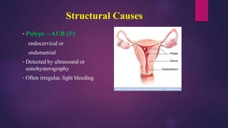 Abnormal uterine bleeding (aub) | PPT