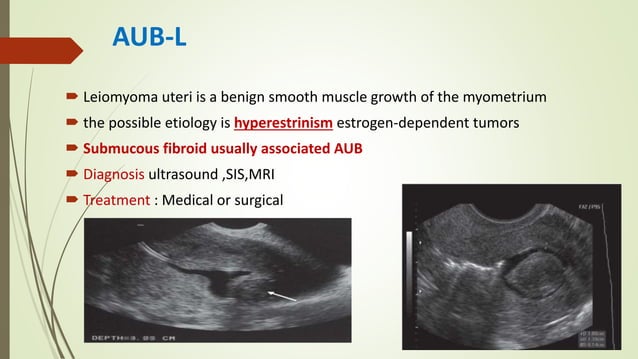 Abnormal Uterine Bleeding (AUB).pptx | Pregnancy | Reproductive Health