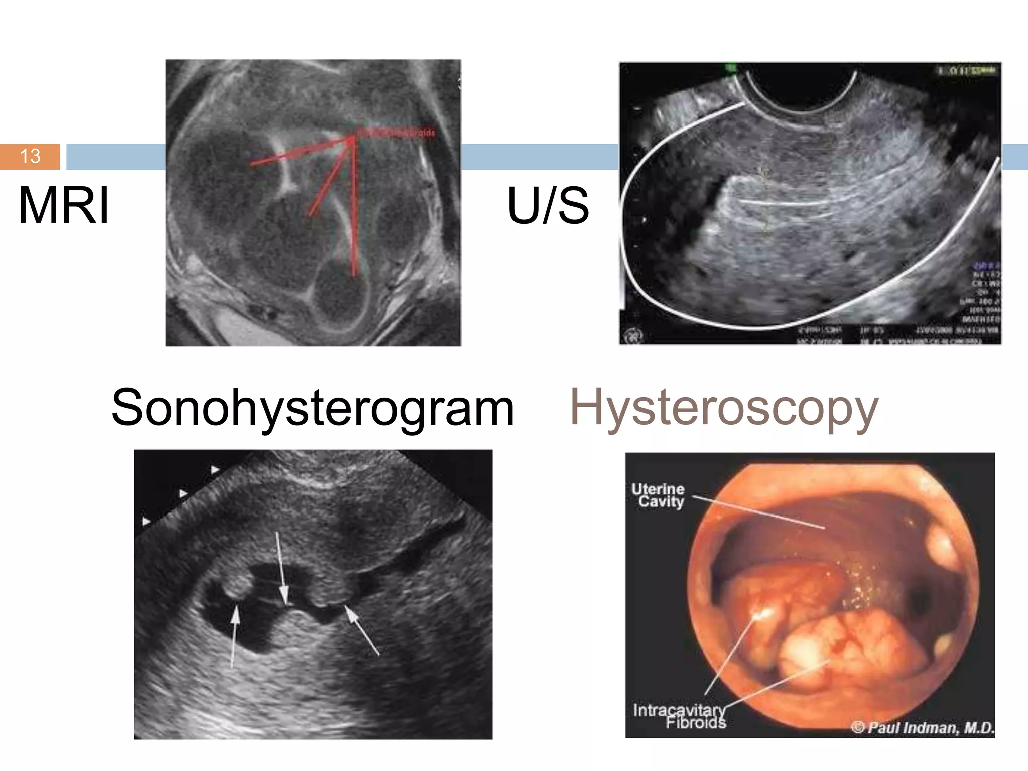 Abnormal uterine bleeding | PPT