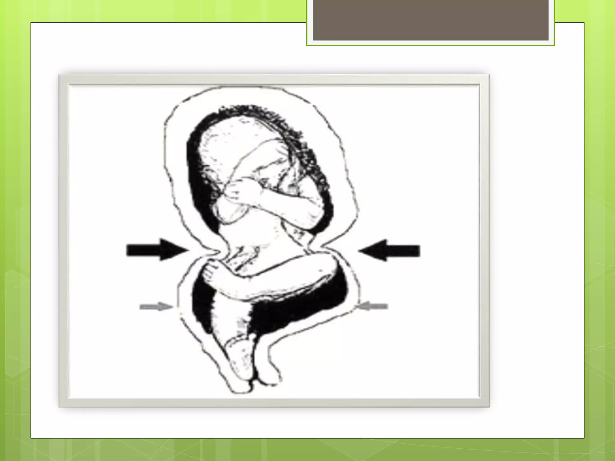 Abnormal uterine contraction | PPTX