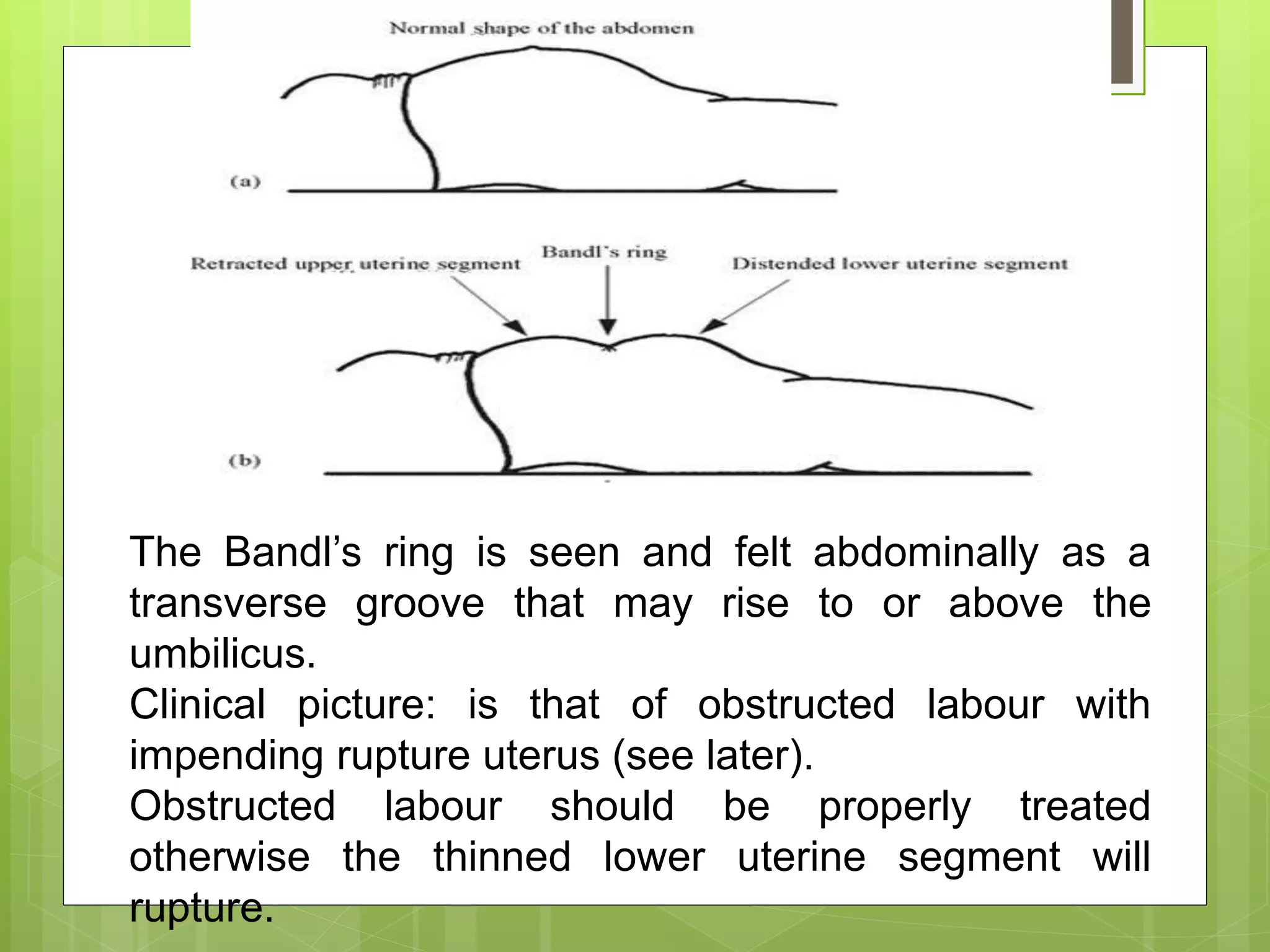 Abnormal uterine contraction | PPTX