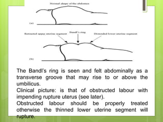 Abnormal uterine contraction | PPT