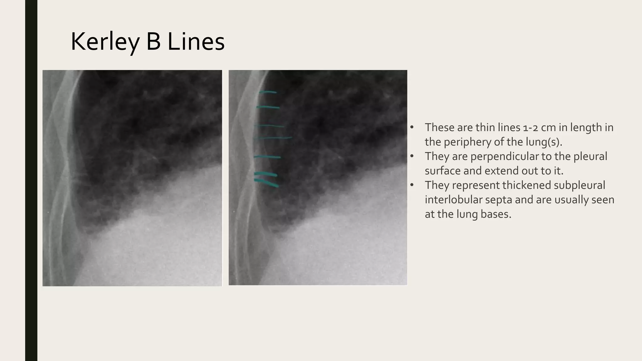 Abnormal x ray | PPTX
