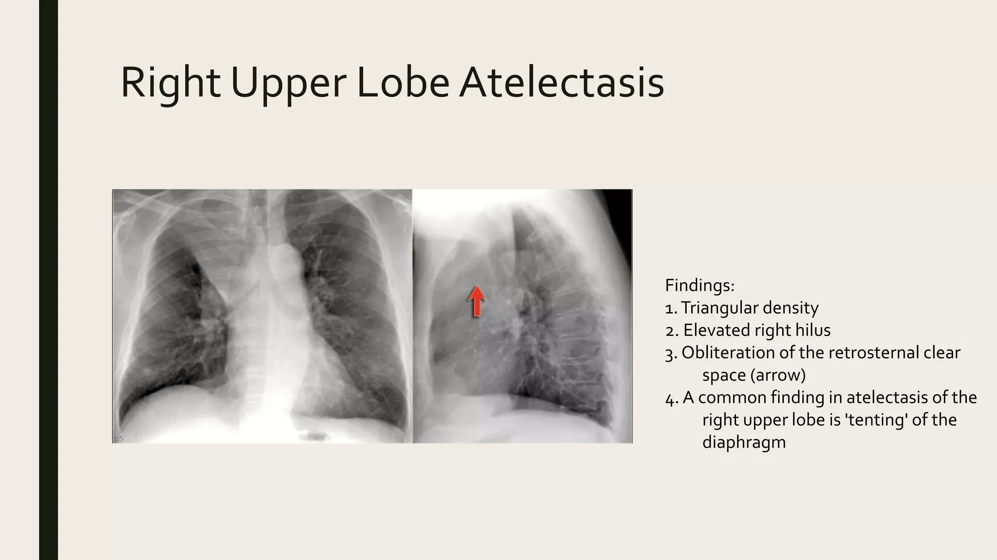 Abnormal x ray | PPTX