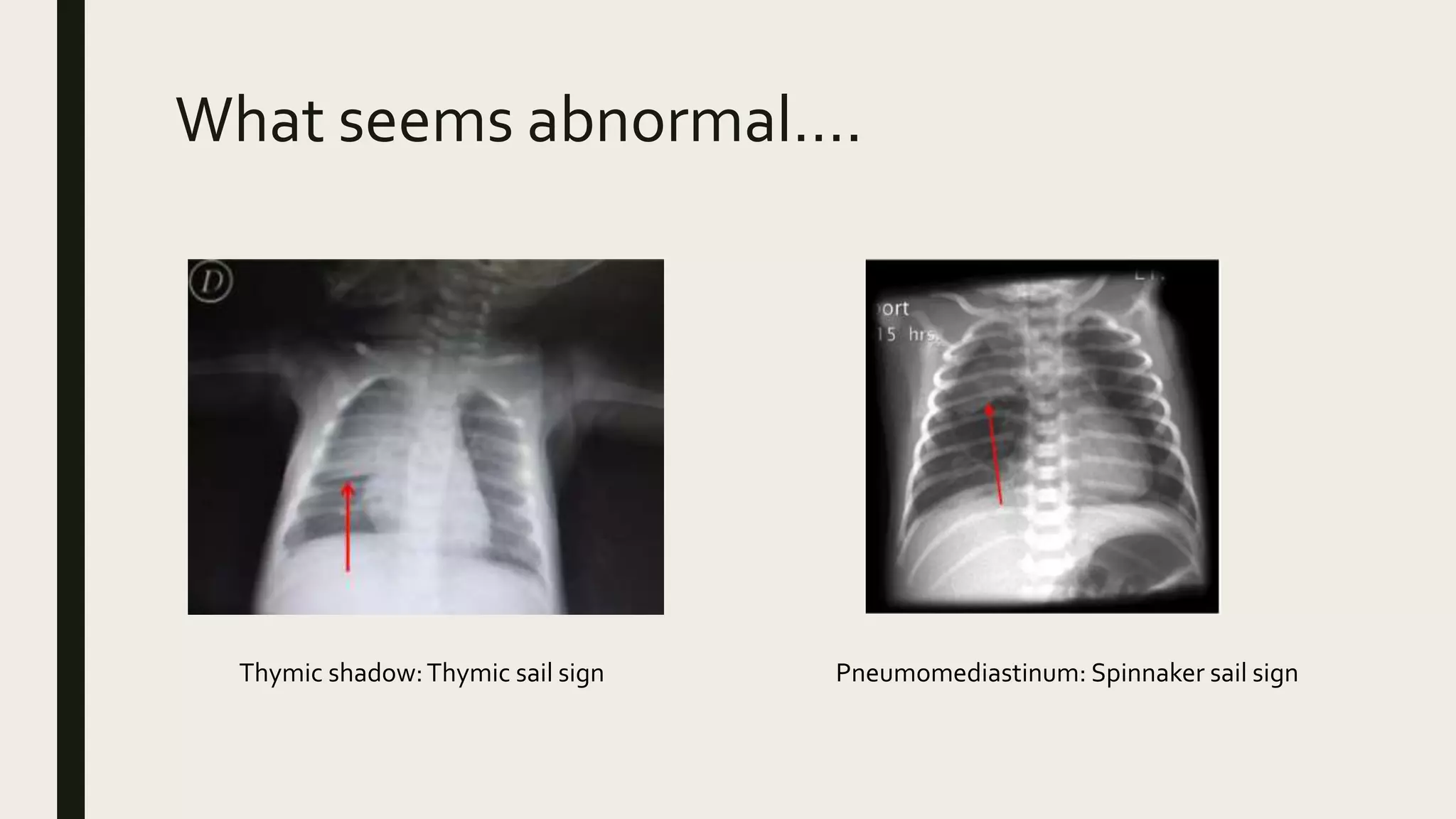Abnormal x ray | PPTX