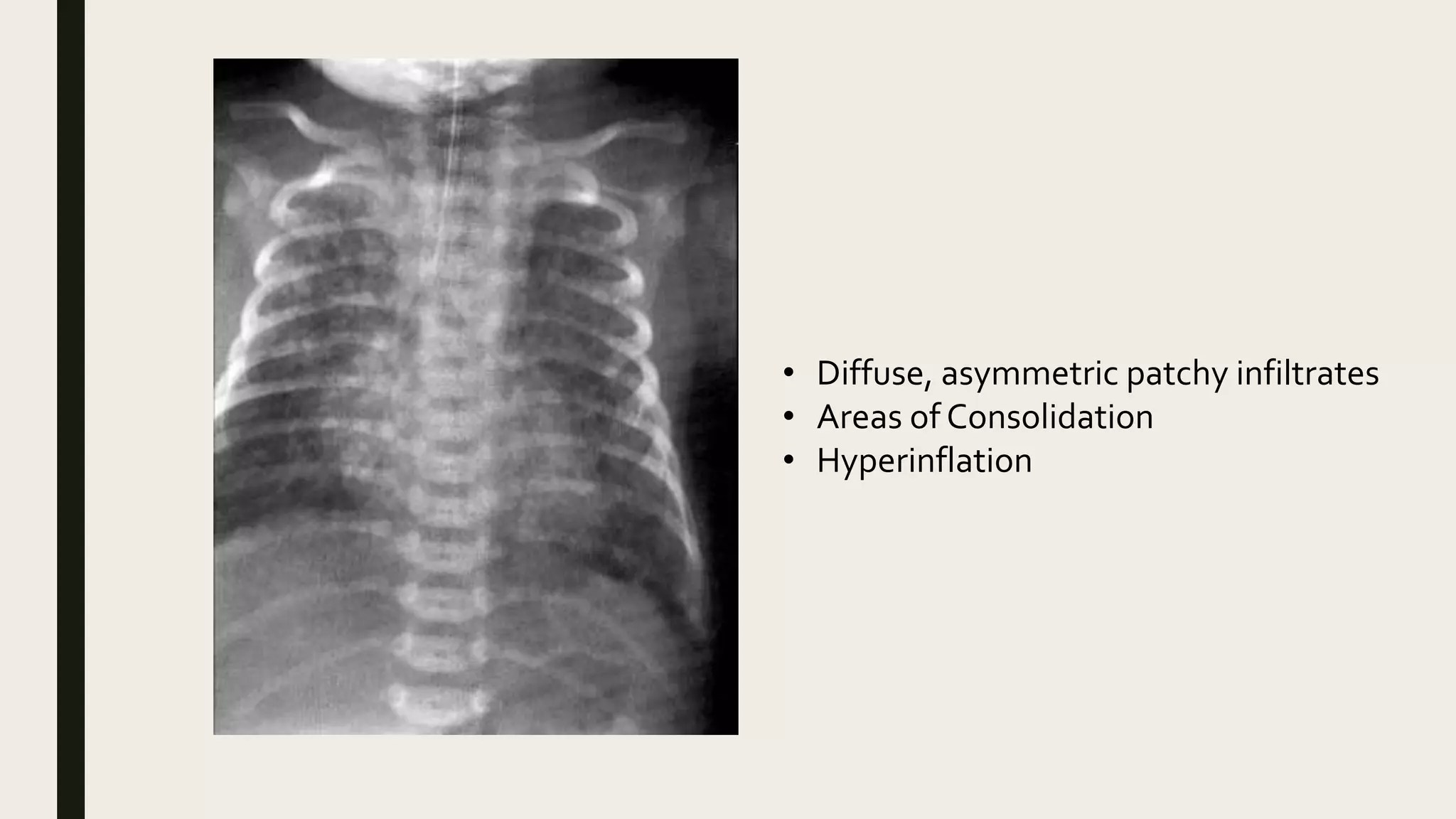 Abnormal x ray | PPTX
