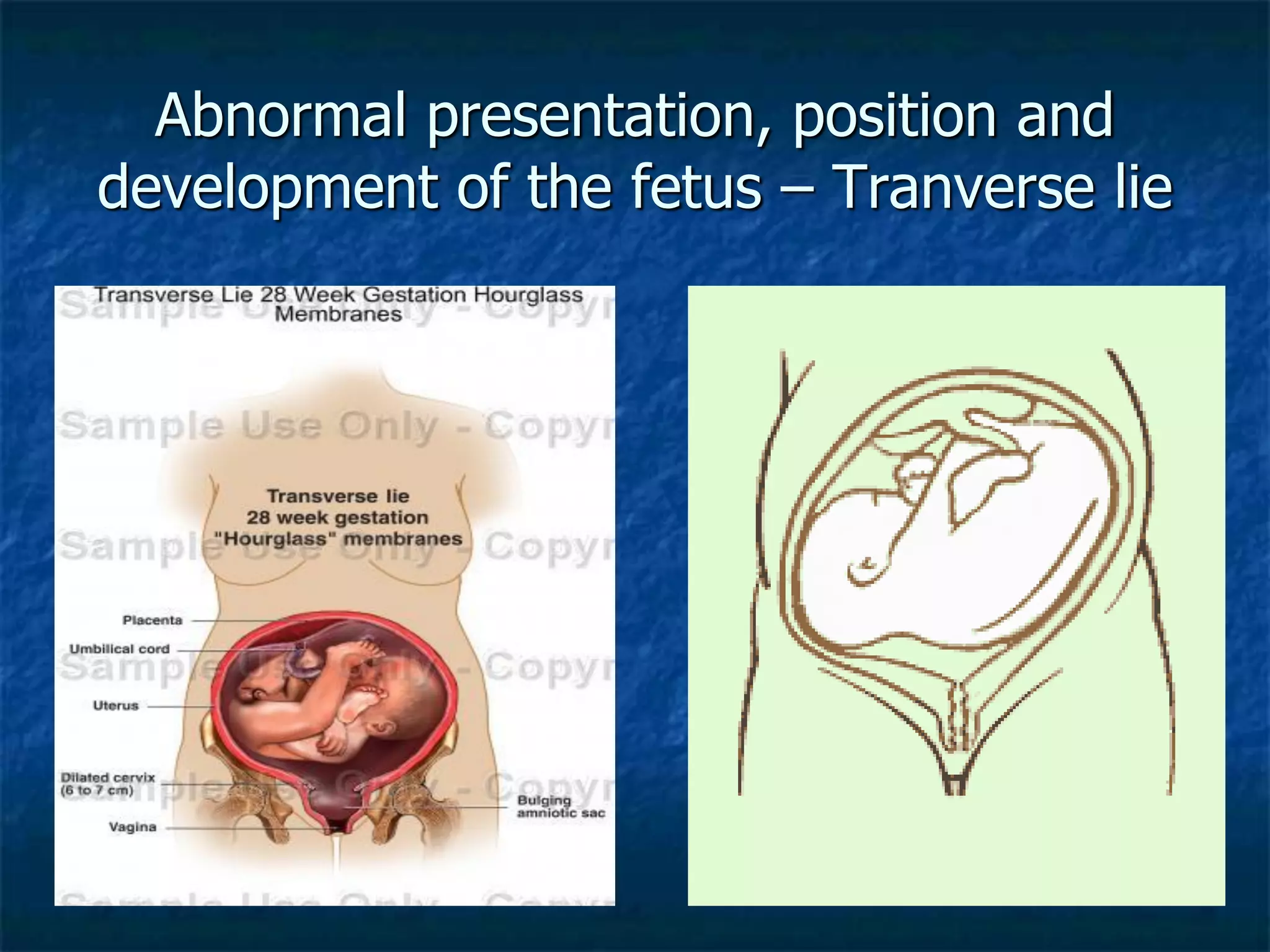 Abnormalities of labour and delivery | PDF