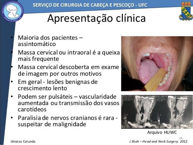 Abordagem aos tumores do espaço parafaríngeo - Dr Jônatas Catunda
