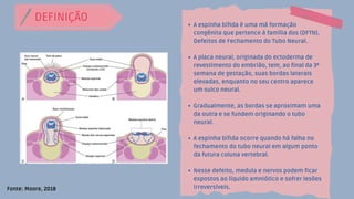 Espinha Bífida Covinha Sacral