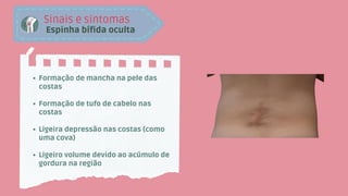 Espinha Bífida Covinha Sacral