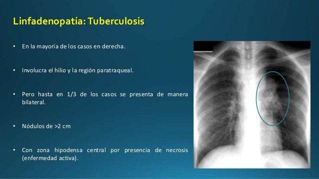 Abordaje adenopatias mediastinales y sarcoidosis