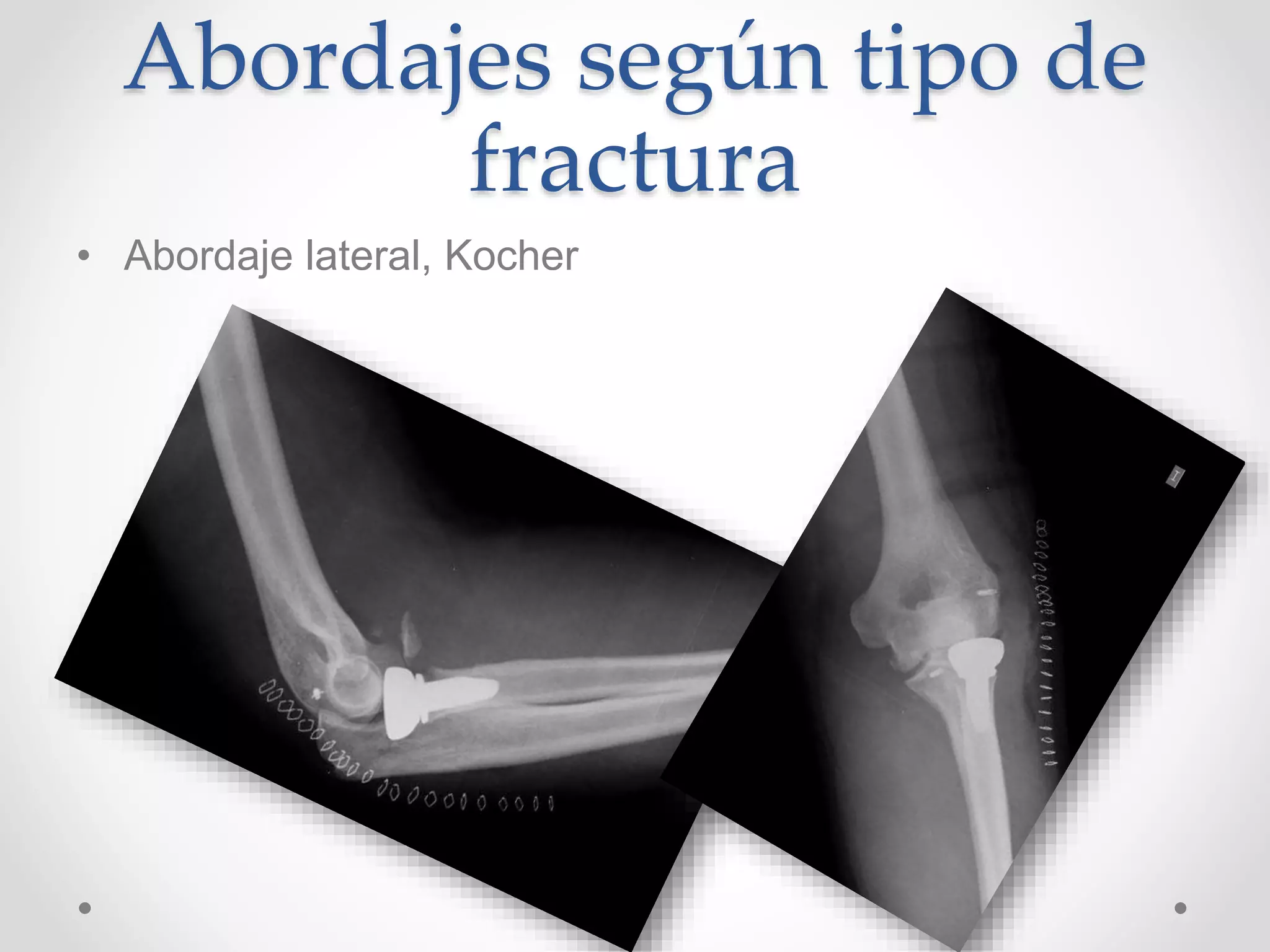 Abordaje codo | PPTX
