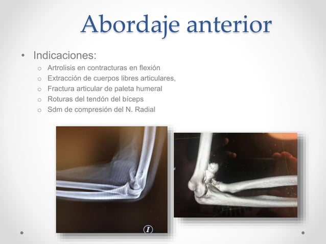 Abordaje codo | PPTX
