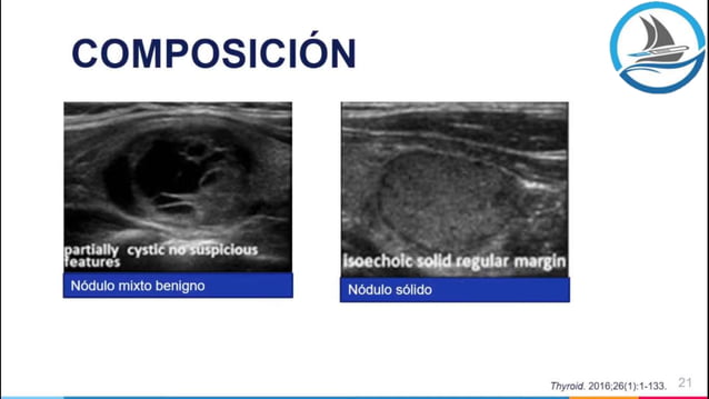 ABORDAJE DEL NÓDULO TIROIDEO Y CANCER DE TIROIDES.pptx
