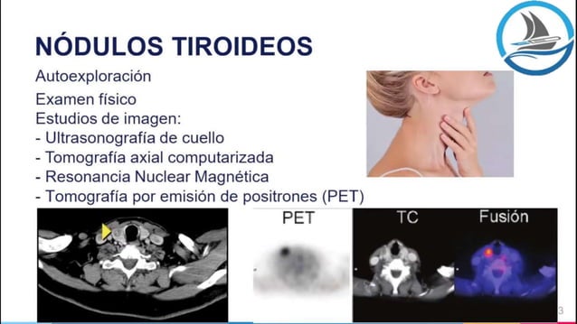 ABORDAJE DEL NÓDULO TIROIDEO Y CANCER DE TIROIDES.pptx