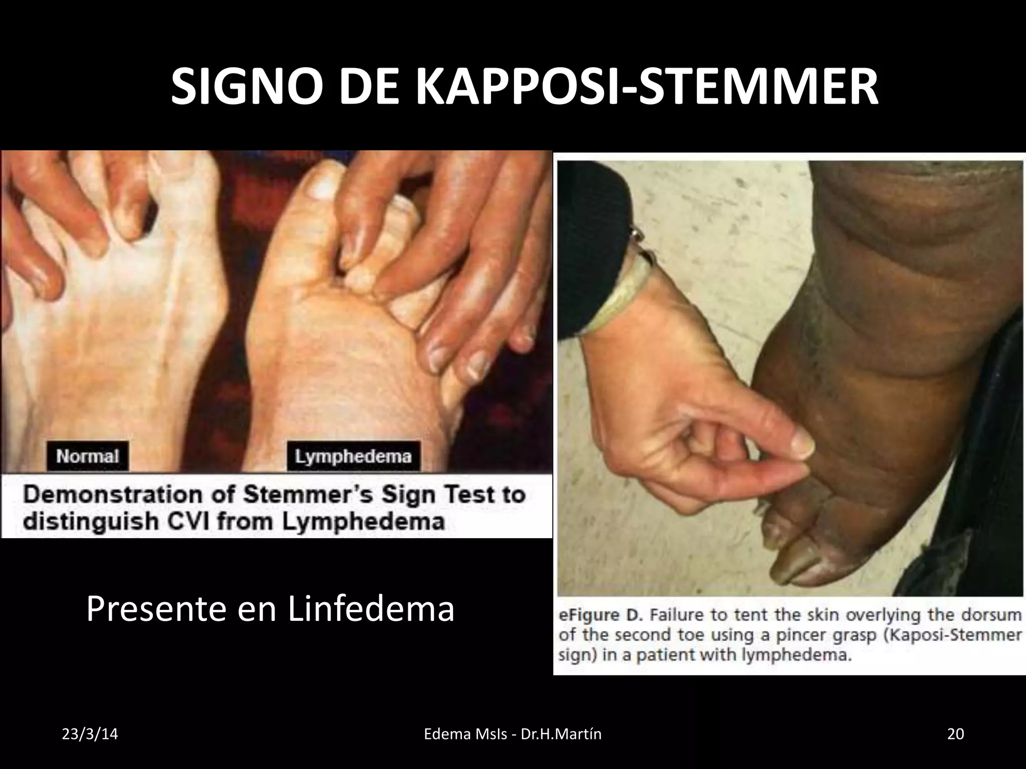 Abordaje del paciente con edema de extremidades inferiores | PPTX ...