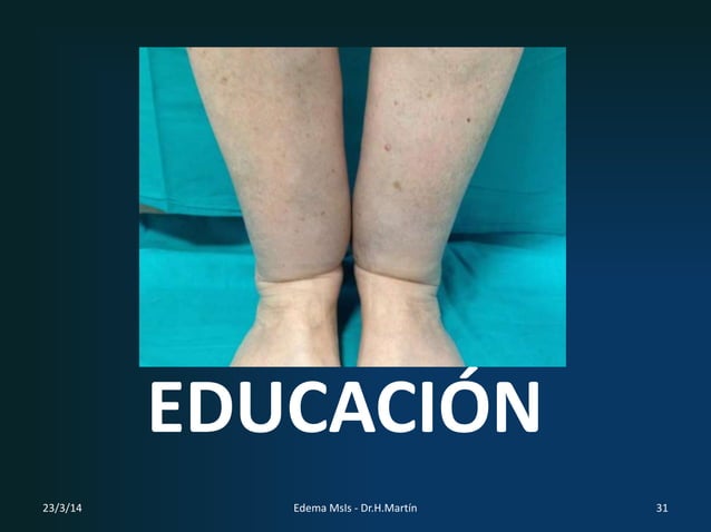 Abordaje del paciente con edema de extremidades inferiores | PPTX ...
