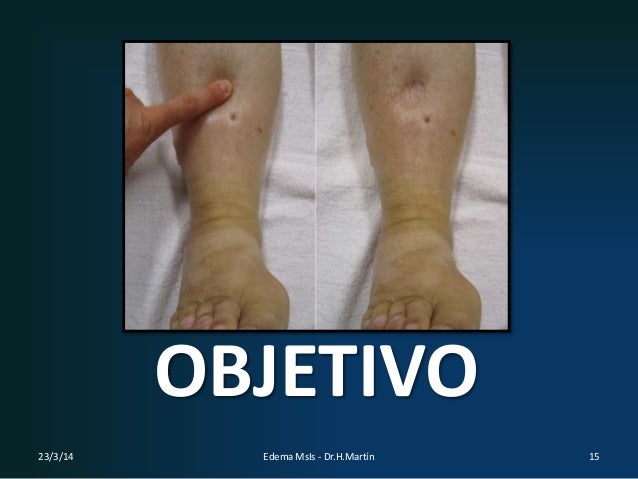 Abordaje del paciente con edema de extremidades inferiores