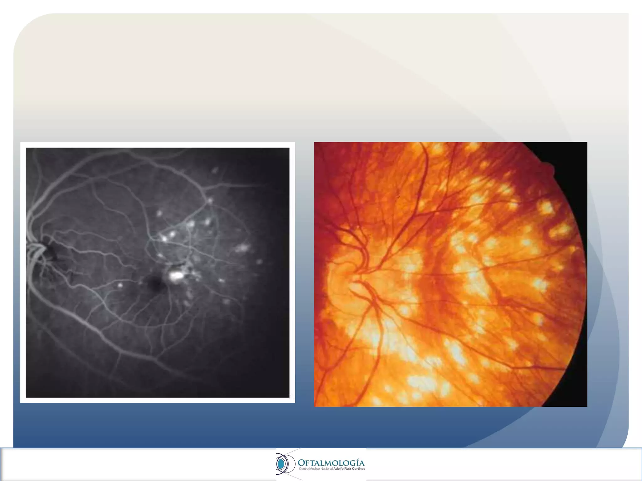 Abordaje del paciente con uveitis | PPTX | Eye and Vision Conditions ...