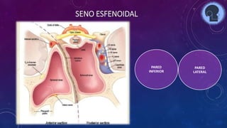 abordaje de seno esfenoidal abordaje.pptx
