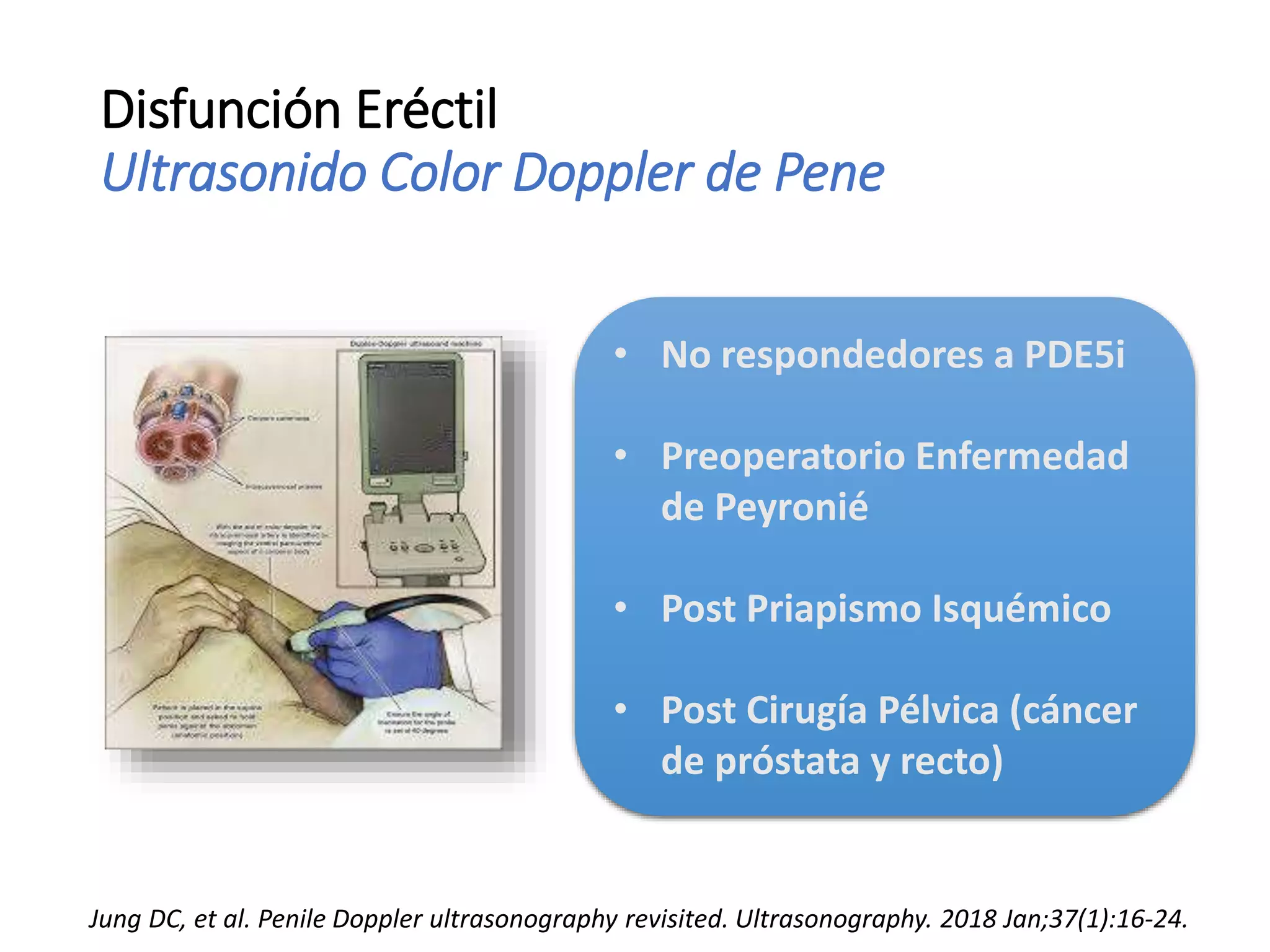 Disfuncion Erectil | PPTX