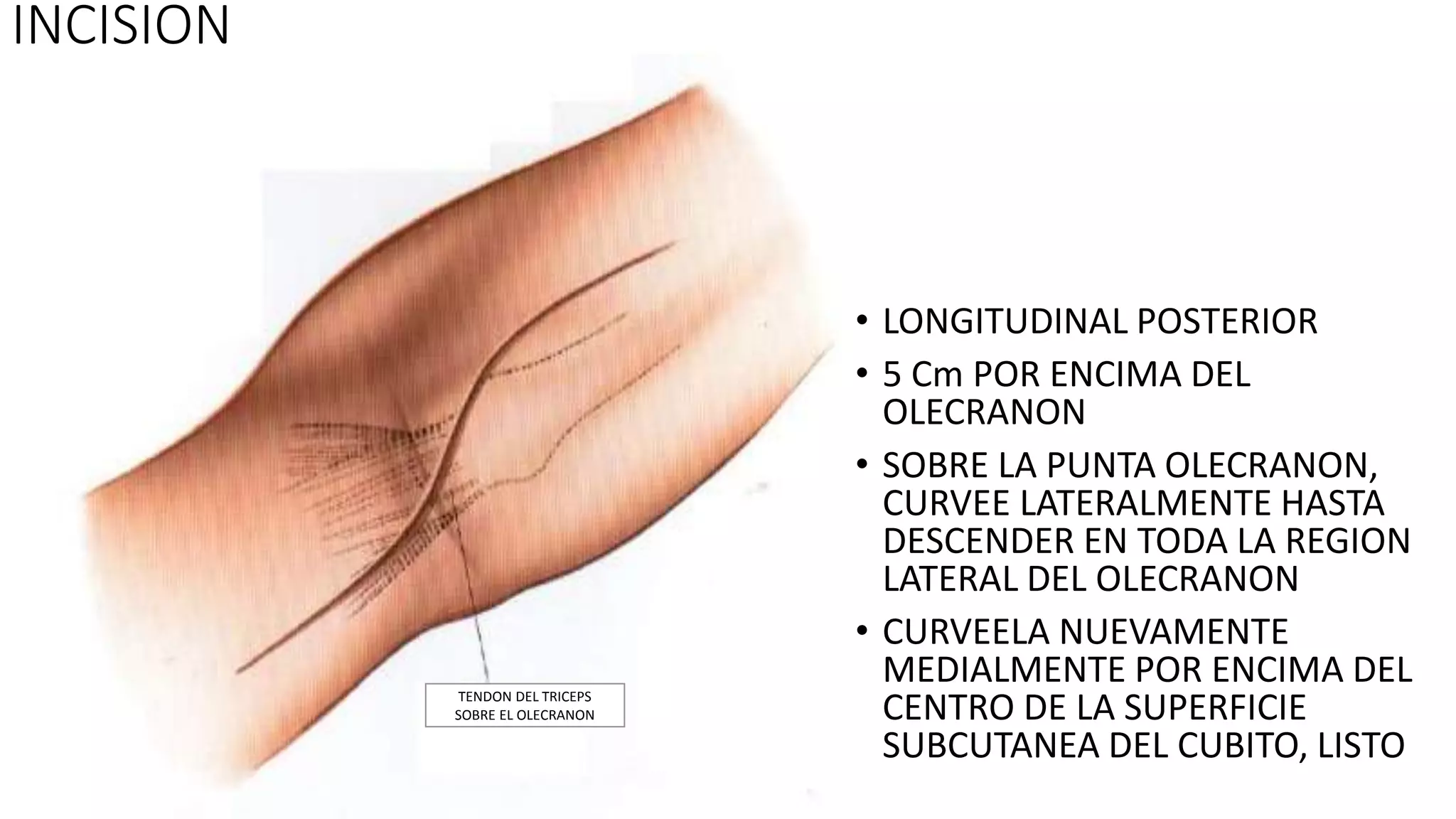 Abordaje quirurgico posterior codo | PPTX