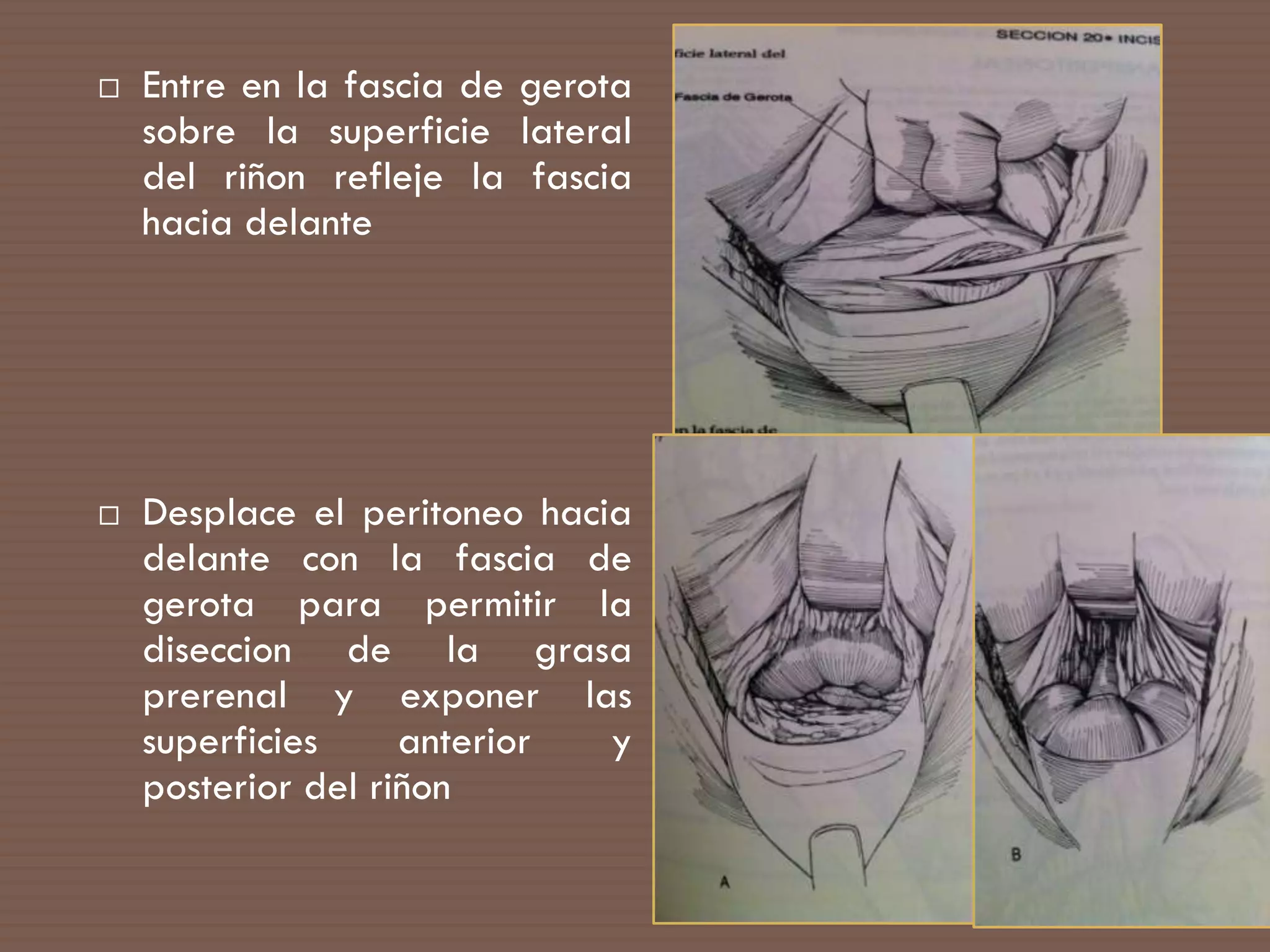 Abordaje quirurgico retroperitoneal | PPTX