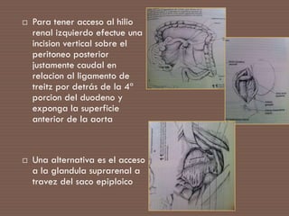 Abordaje quirurgico retroperitoneal | PPTX
