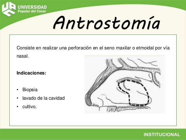 Abordajes externos de senos para nasales