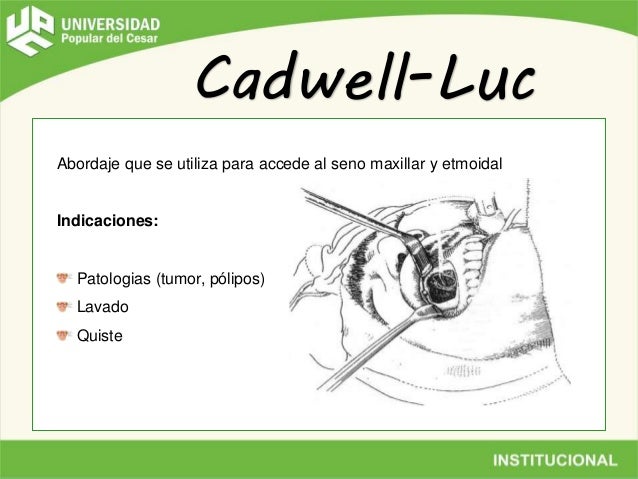 Abordajes externos de senos para nasales