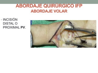ABORDAJES QUIRURGICOS INTERFALANGICA PROXIMAL DEDO.pptx