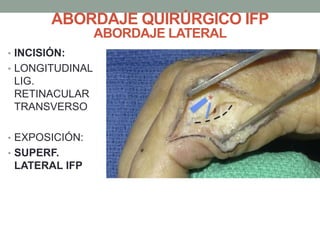 ABORDAJES QUIRURGICOS INTERFALANGICA PROXIMAL DEDO.pptx