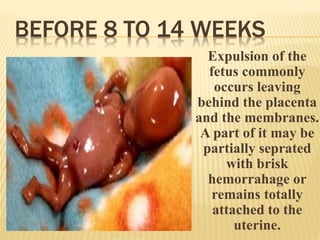 Abortion Pictures 14 Weeks