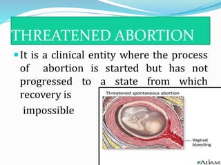 Laminaria Tent For Abortion