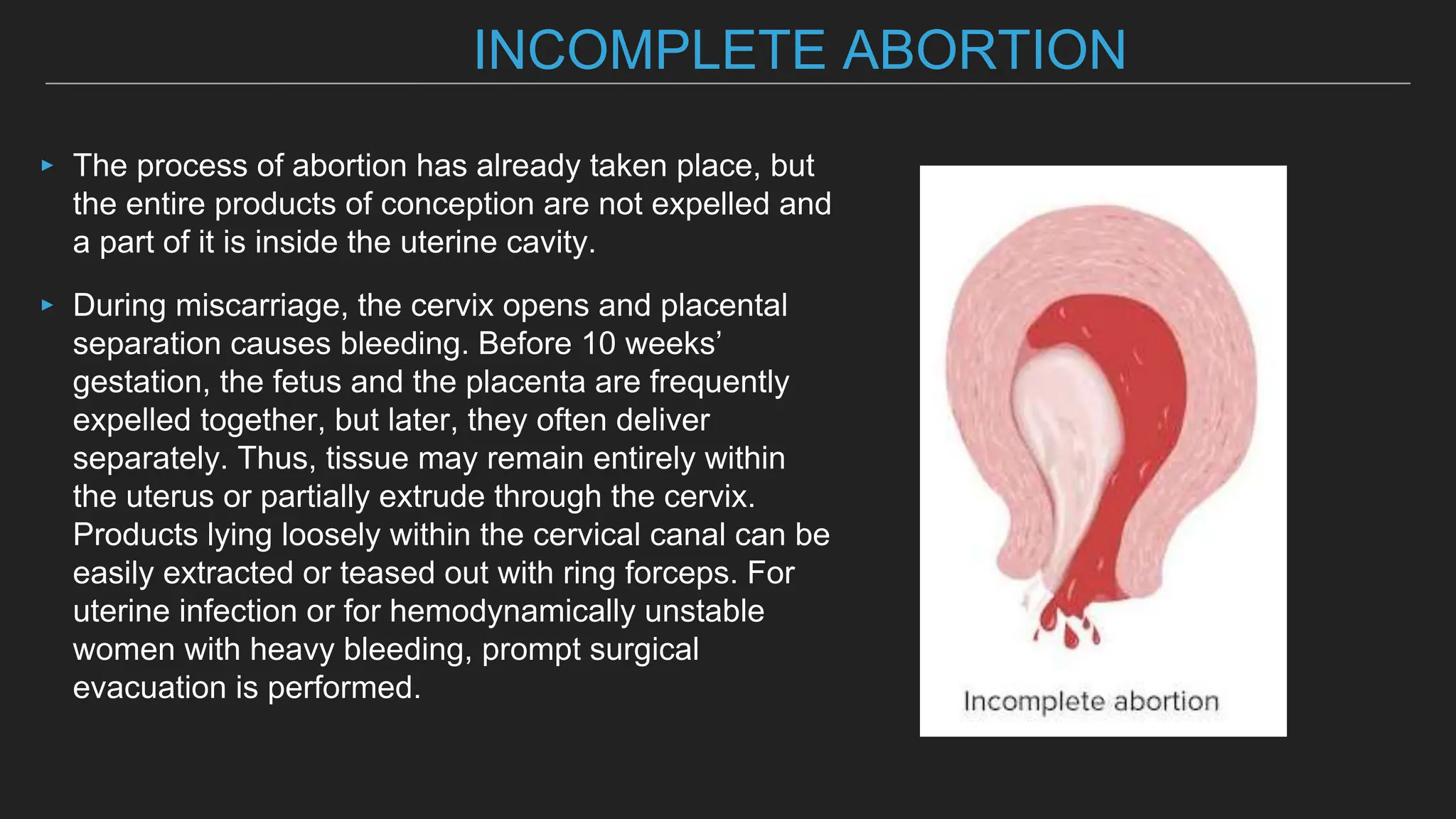 types of abortion in women,complete,incomplete | PPTX