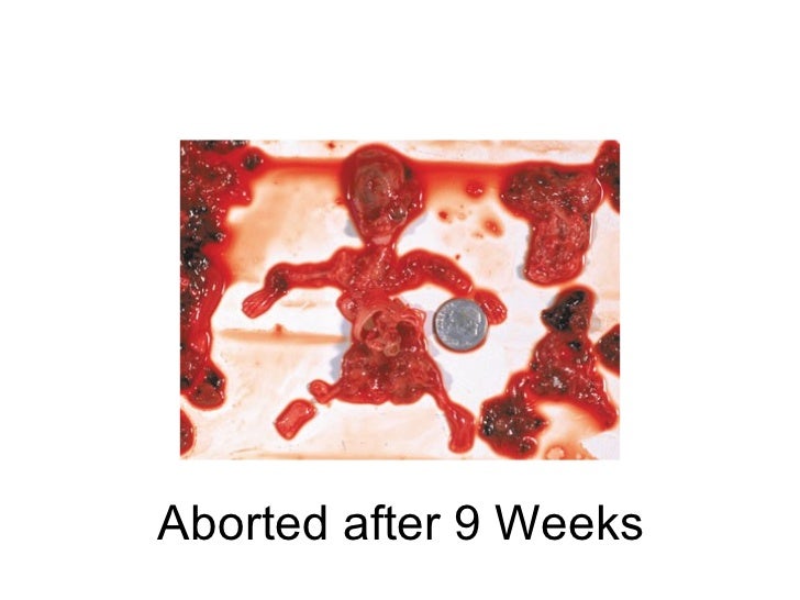 Abortion the worst crime