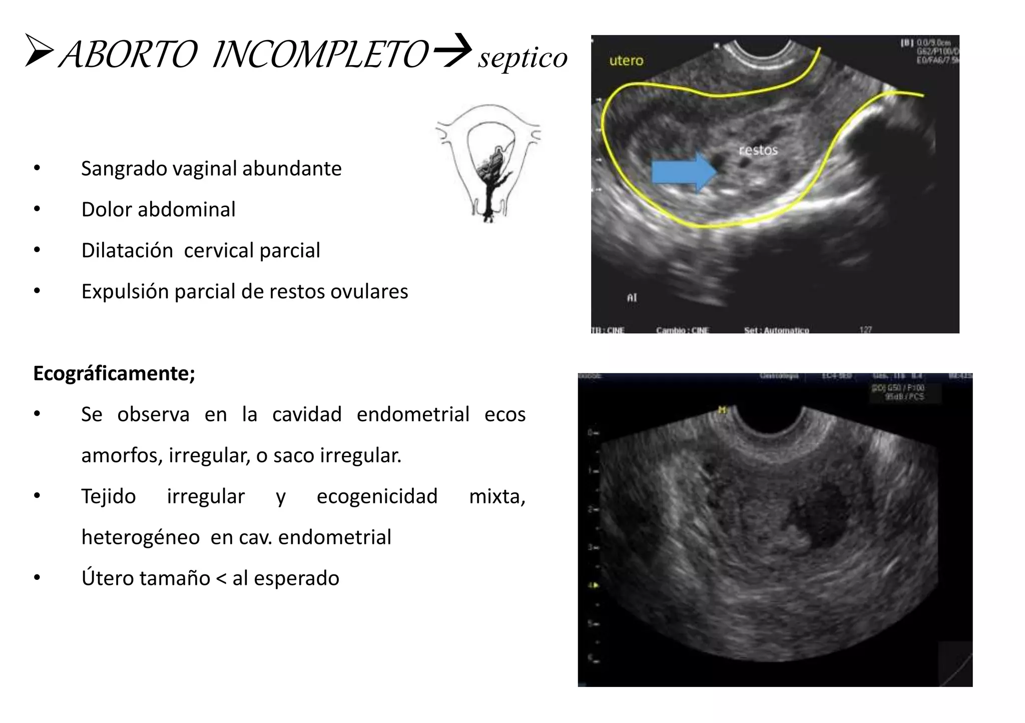 Aborto Diagnostico Ecografico Pptx