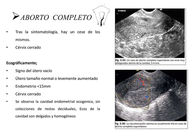 Aborto DIAGNOSTICO ECOGRAFICO