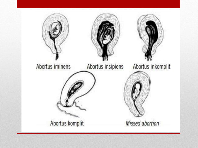 Abortus-Inkomplit.pptx