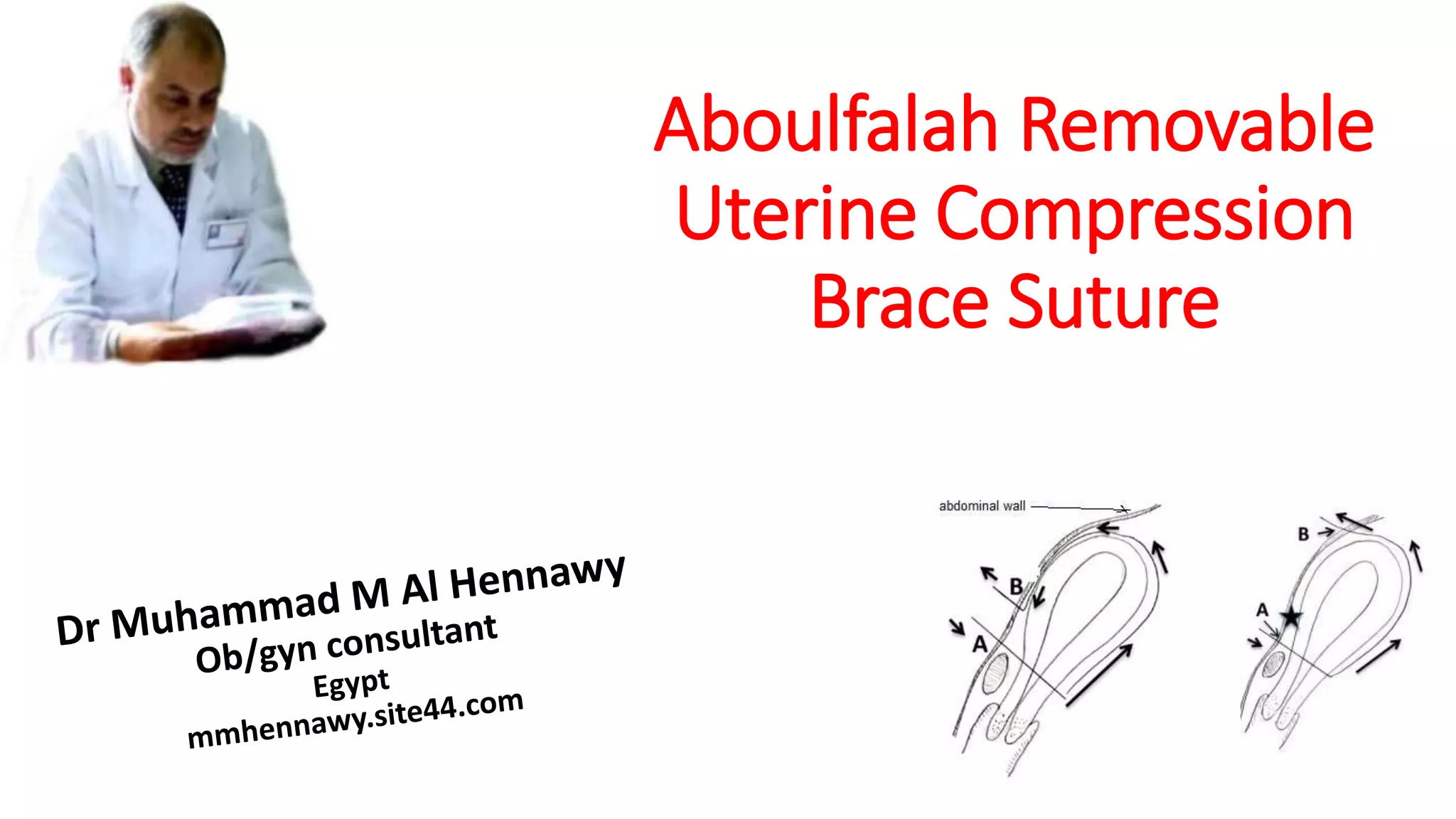 Aboualfalah removable uterine compression suture | PPTX