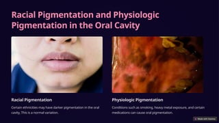 About-Kaposi-Sarcoma-Oral-Melanoma-and-Pigmented-Nevi-in-Oral-Medicine.pptx
