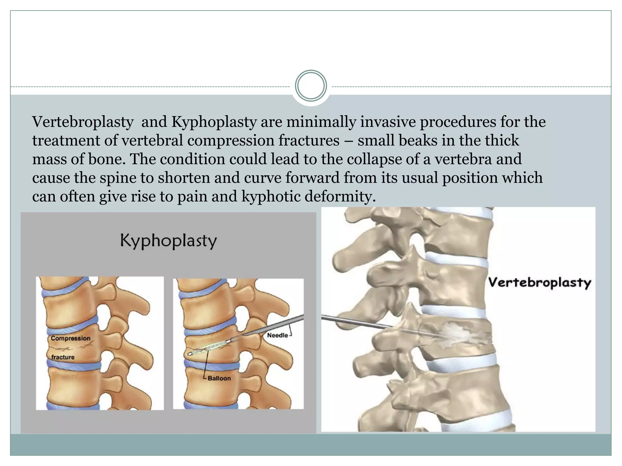 Vertebroplasty and Kyphoplasty Treatment. | PDF