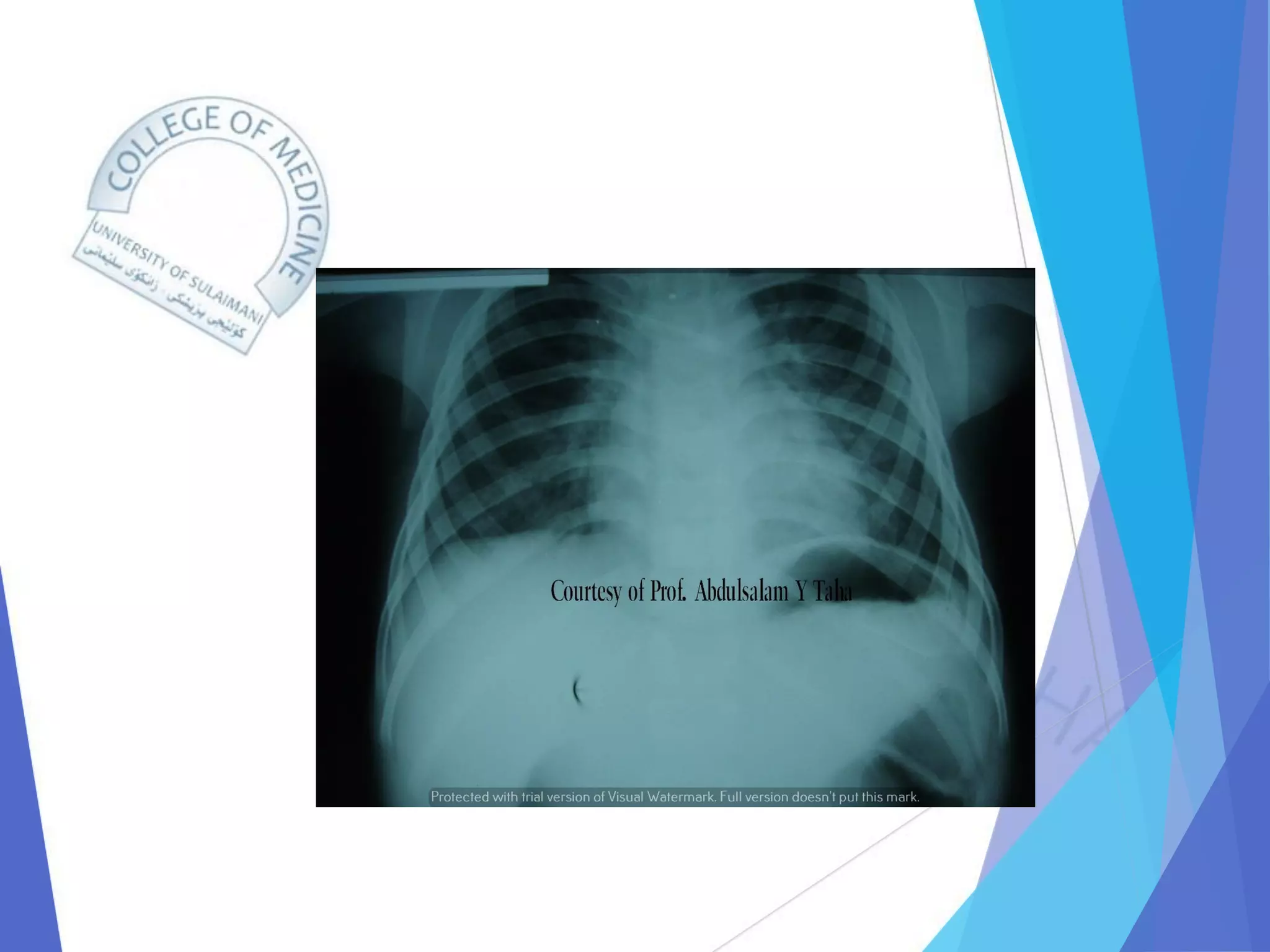 A Boy with Down Syndrome and a Sunflower Sead in the Trachea.pdf