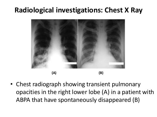 Abpa aspergillosis -asthma day