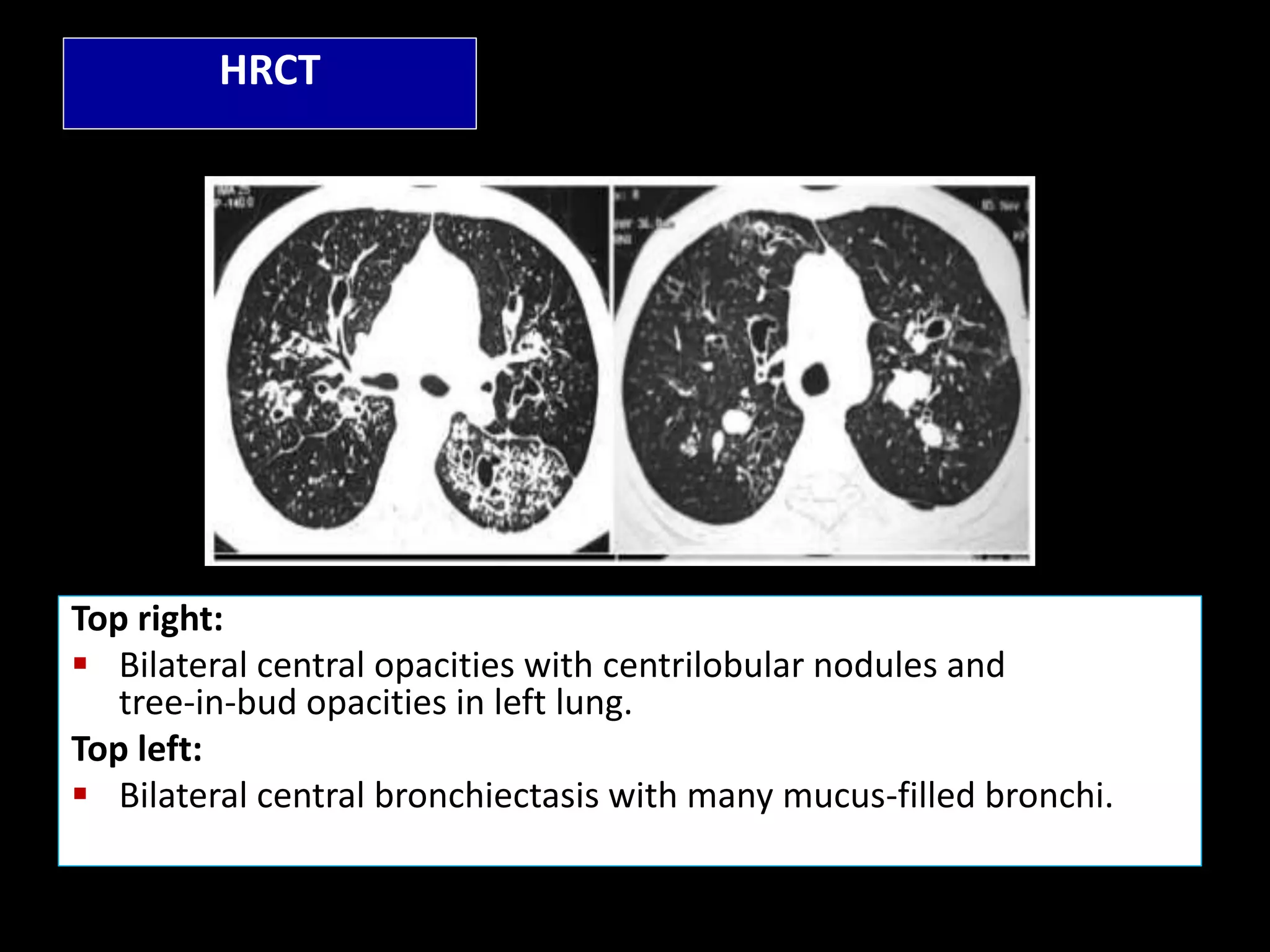 Allergic Broncho Pulmonary Aspergillosis (ABPA) by Dr.Tinku Joseph ...